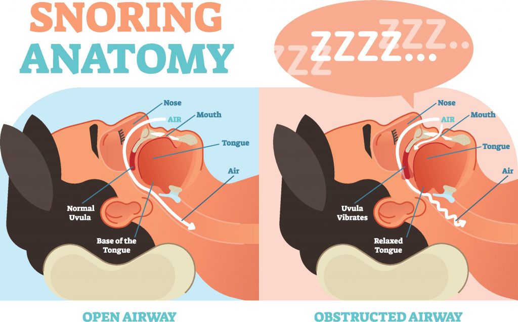 How do I get an oral appliance for my snoring? | Alexandra Dental Clinic